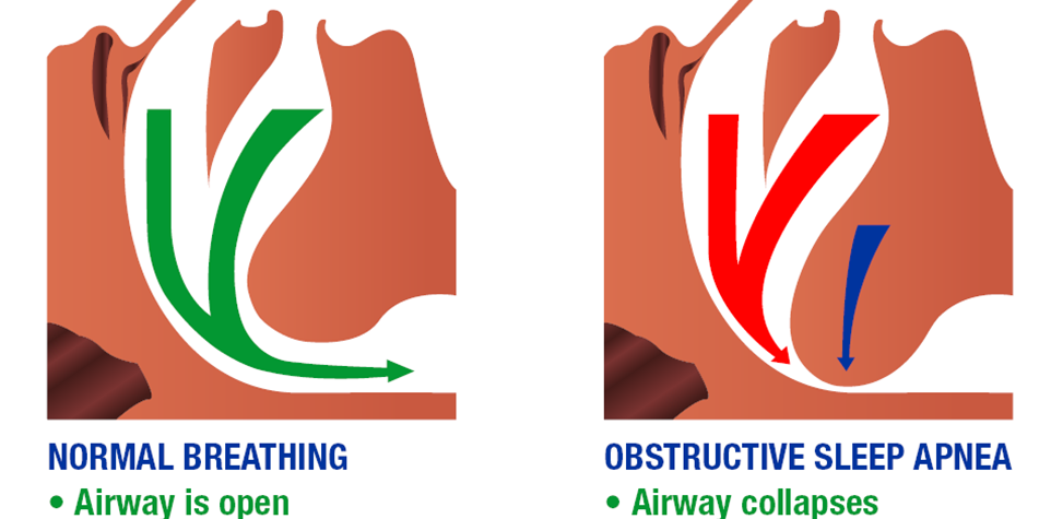 Obstructive Sleep Apnea – California Sleep Solutions