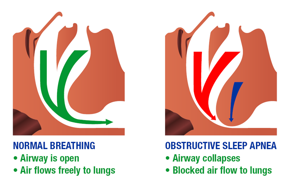 Obstructive Sleep Apnea – California Sleep Solutions